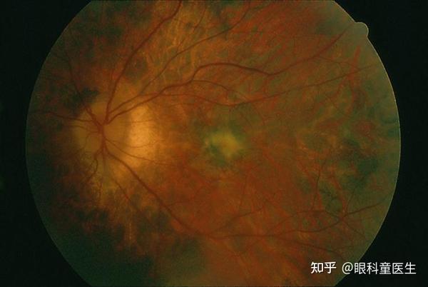 后葡萄膜炎——19、急性区域性隐匿性外层视网膜病变 - 知乎