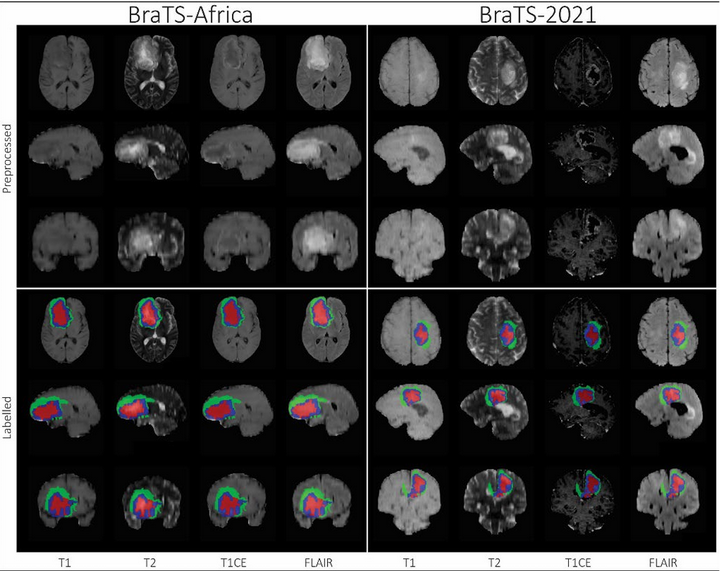 BraTS2023-SSA 数据集介绍 - 知乎