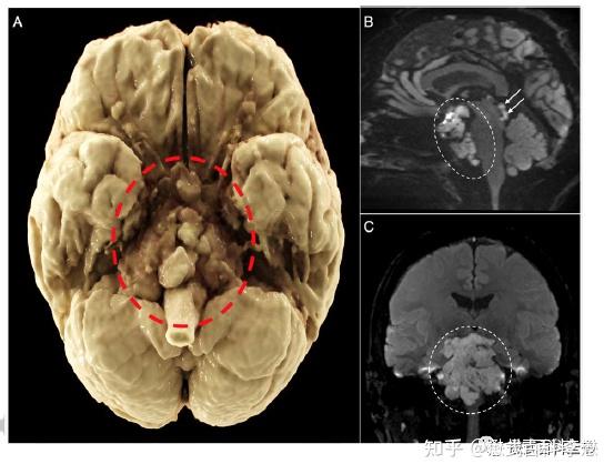 “3D”弥散（扩散）序列的临床应用 - 知乎