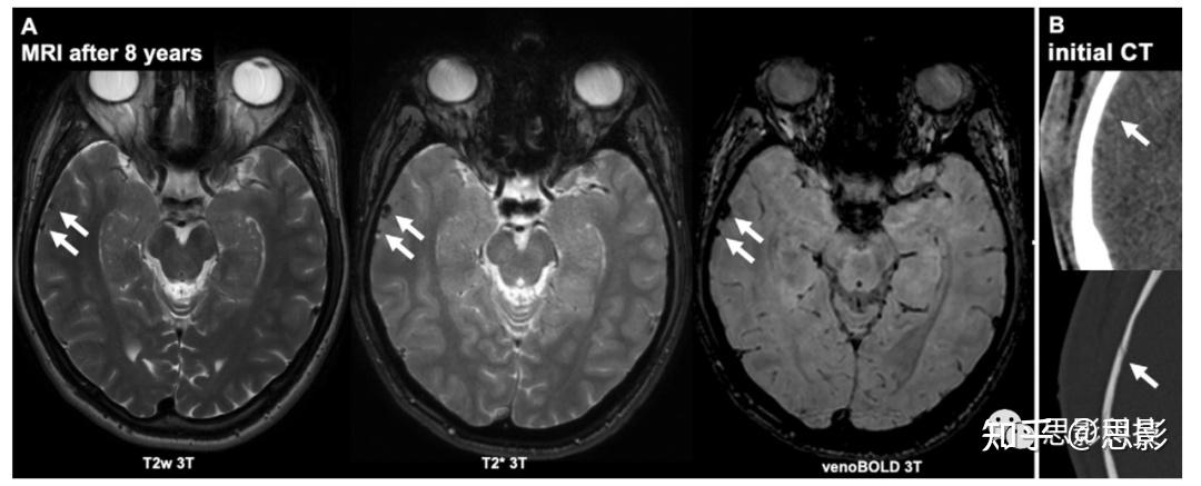 磁敏感加权成像（SWI)：技术要点和临床神经学应用 - 知乎