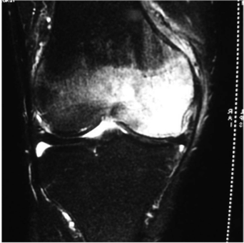 SONK（Spontaneous osteonecrosis of the knee）的诊断及治疗概述 - 知乎