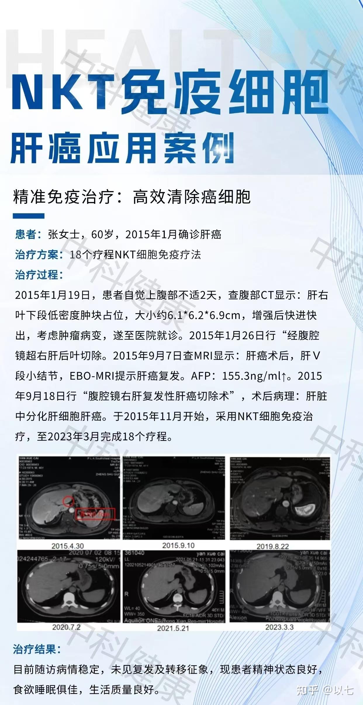 NKT细胞免疫疗法：肿瘤患者的新希望（附应用案例） - 知乎