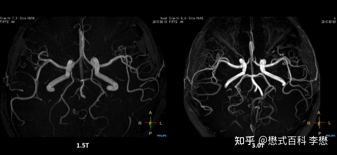 MRI基础知识——SNR与场强的关系 - 知乎
