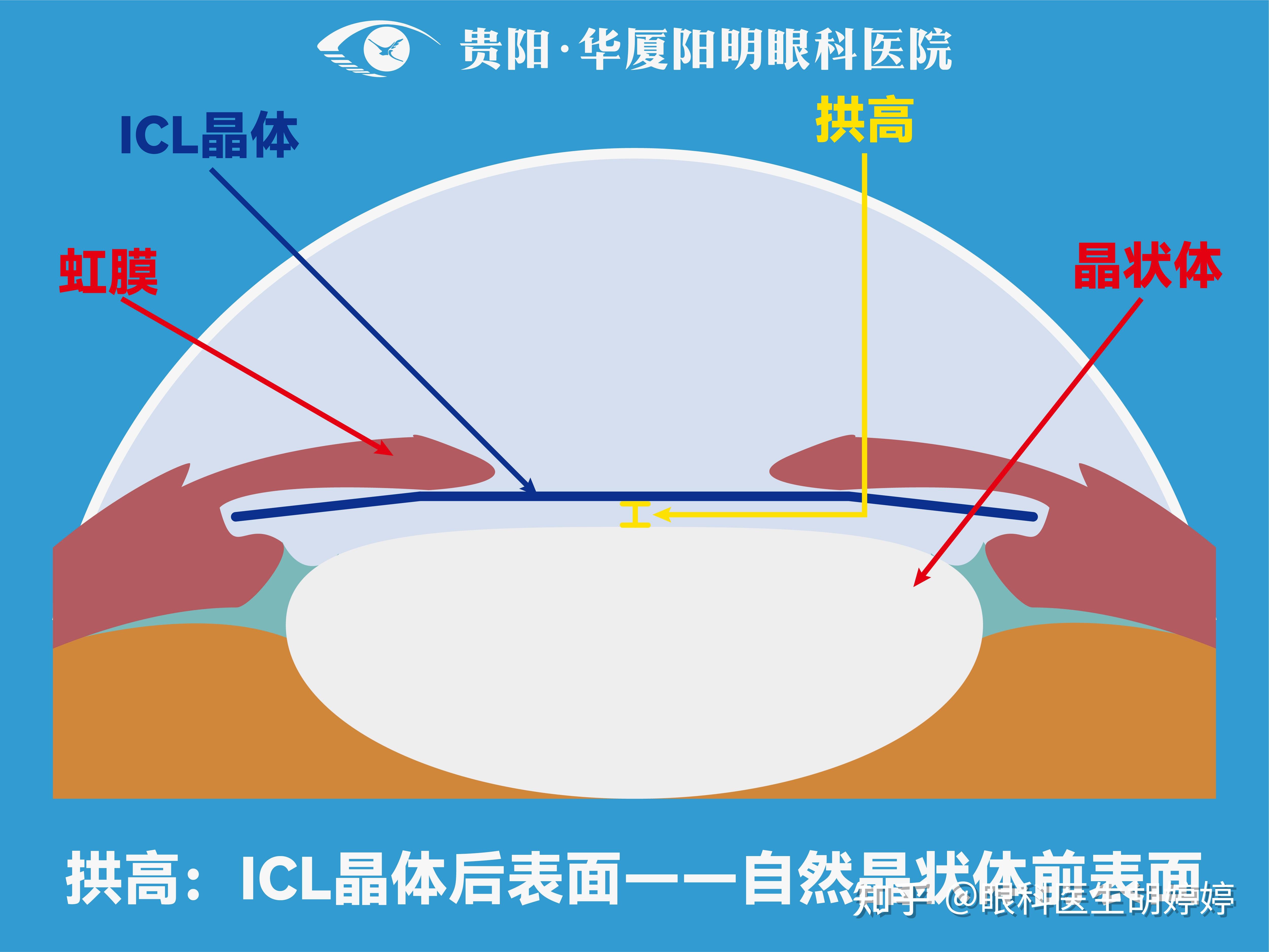 ICL晶体植入近视手术做完后晶体容易位移吗？ - 知乎