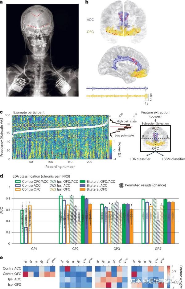 Nat Neurosci︱重大发现！首次使用颅内神经生物标志物预测慢性疼痛状态 - 知乎