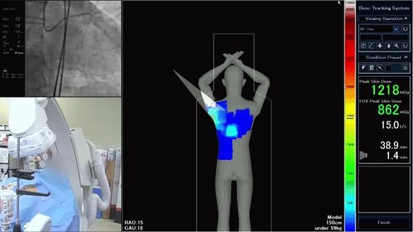 一文盘点全线DSA产品：佳能医疗篇 - 知乎
