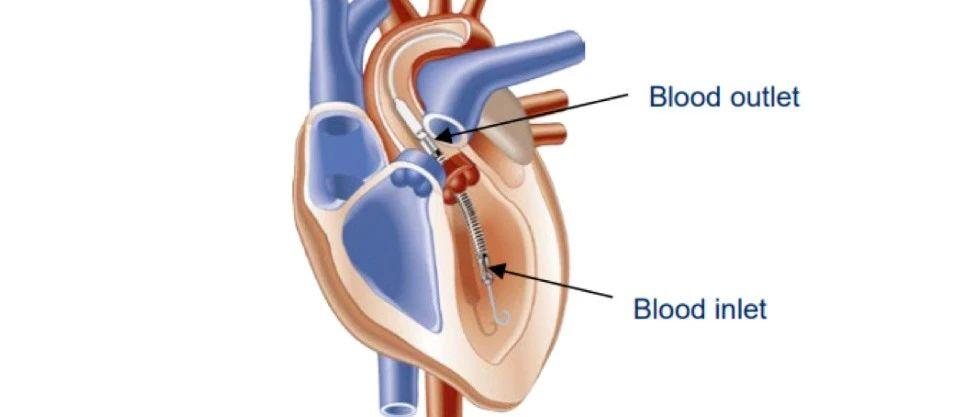 Impella发展历程、临床效果及临床应用价值 - 知乎