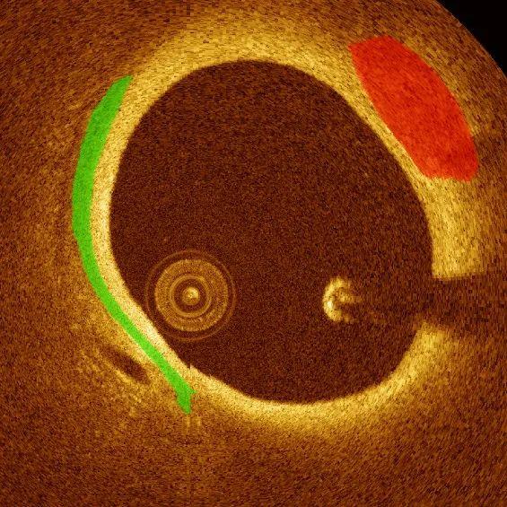 CCEC·前沿技术｜当人工智能“预见”OCT - 知乎