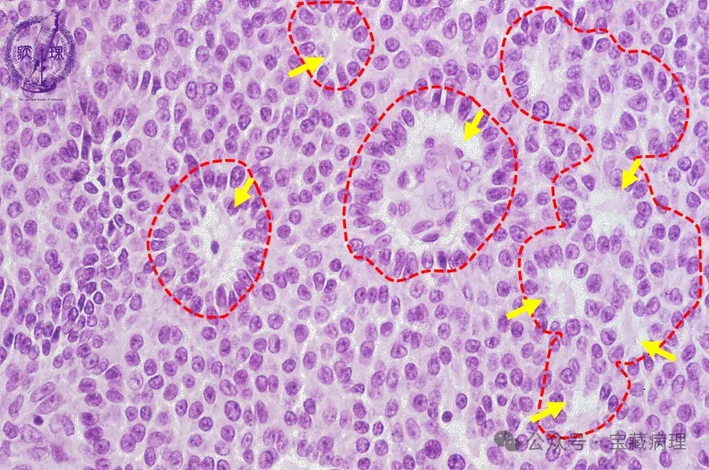 探秘Call-Exner小体【病理诊断须知】 - 知乎