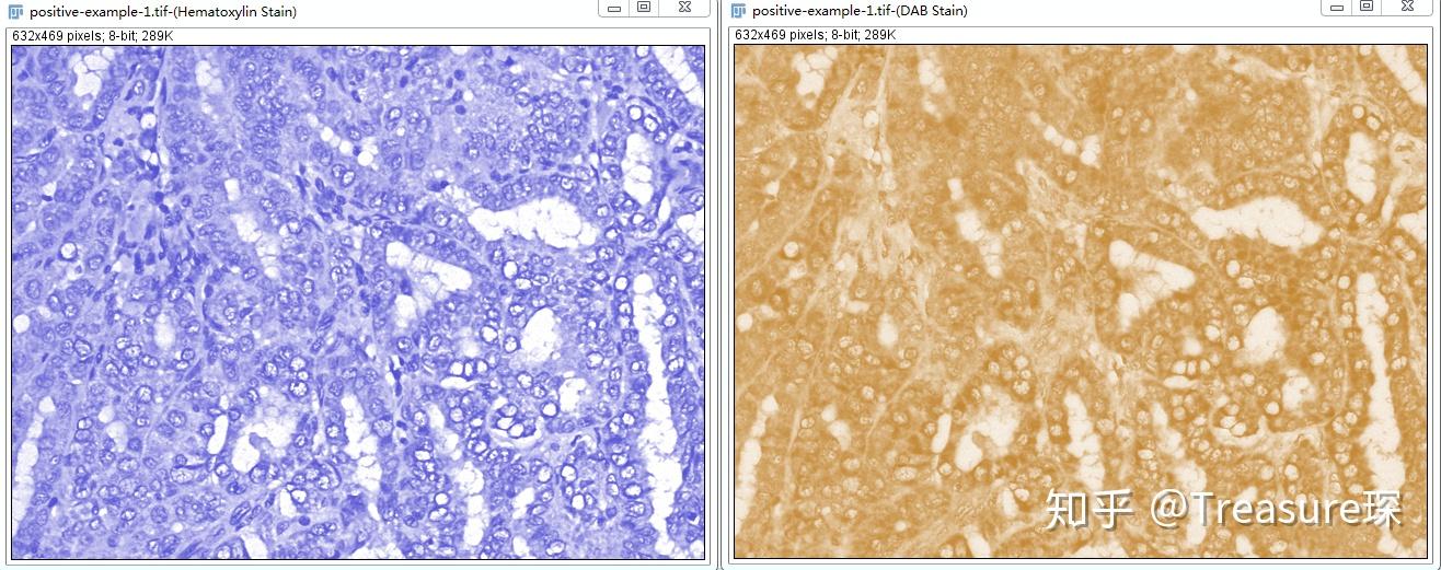 ImageJ实用技巧——免疫组化分析(定量分析篇) - 知乎