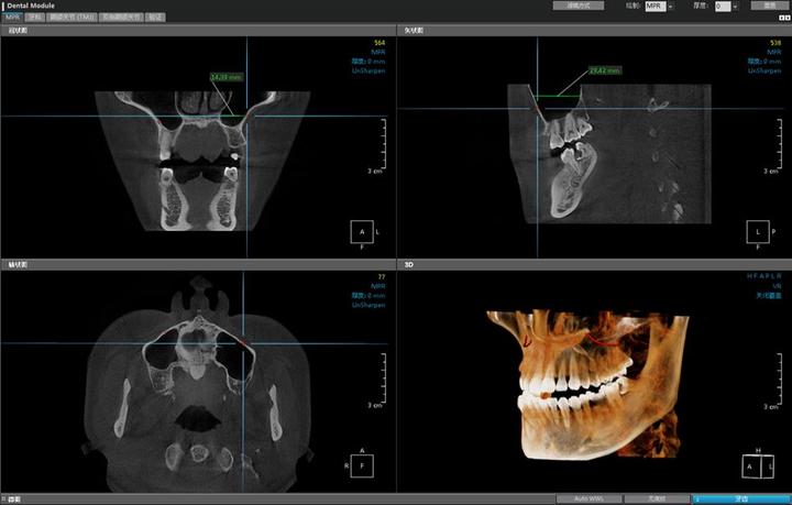 招飞体检耳鼻喉常见加项检查：锥形束CT检查（CBCT） - 知乎