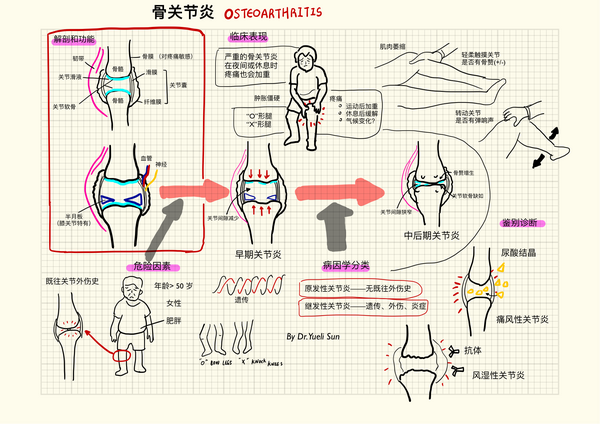 孙悦礼 的 Live －－ 重新认识膝骨关节炎 - 知乎