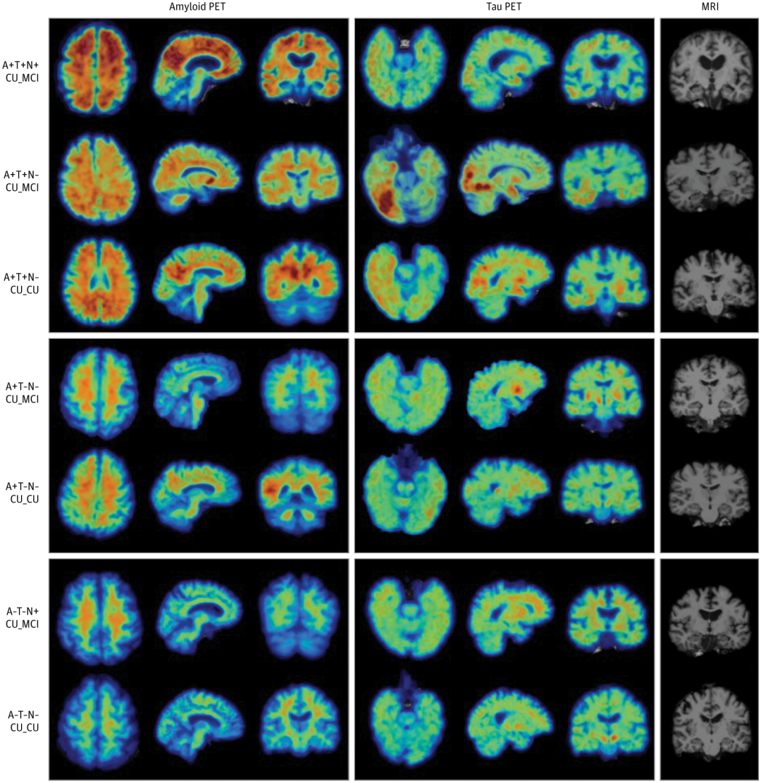 无认知障碍老人Amyloid和Tau PET信号可预测阿尔茨海默病症状发展 - 知乎