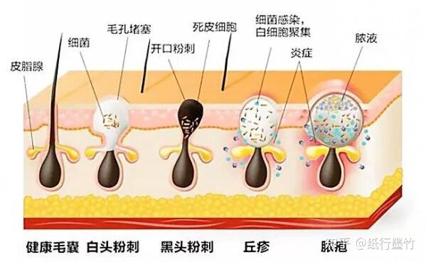 黑头总也去不干净？快试试这几个去黑头方法 知乎