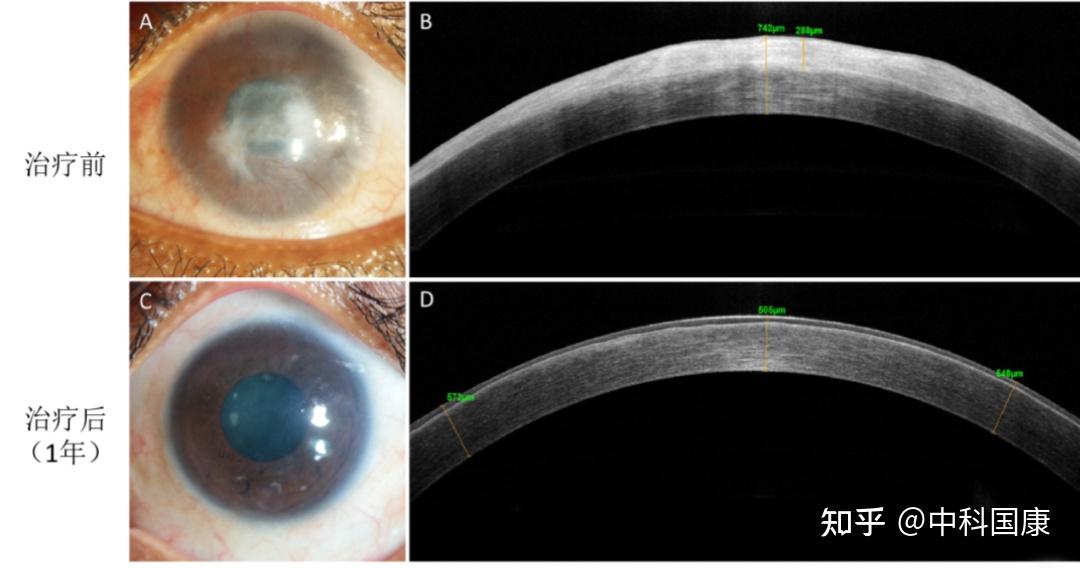 眼睛角膜的拯救者：干细胞重建角膜恢复视力 - 知乎