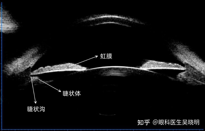 ICL晶体植入术前检查之UBM，为什么术前要做UBM检查？ - 知乎