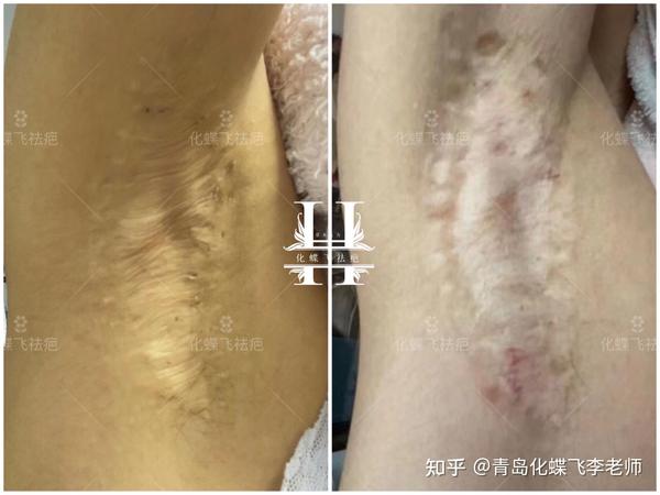 郑州护士小姐姐的腋下手术疤痕 - 知乎