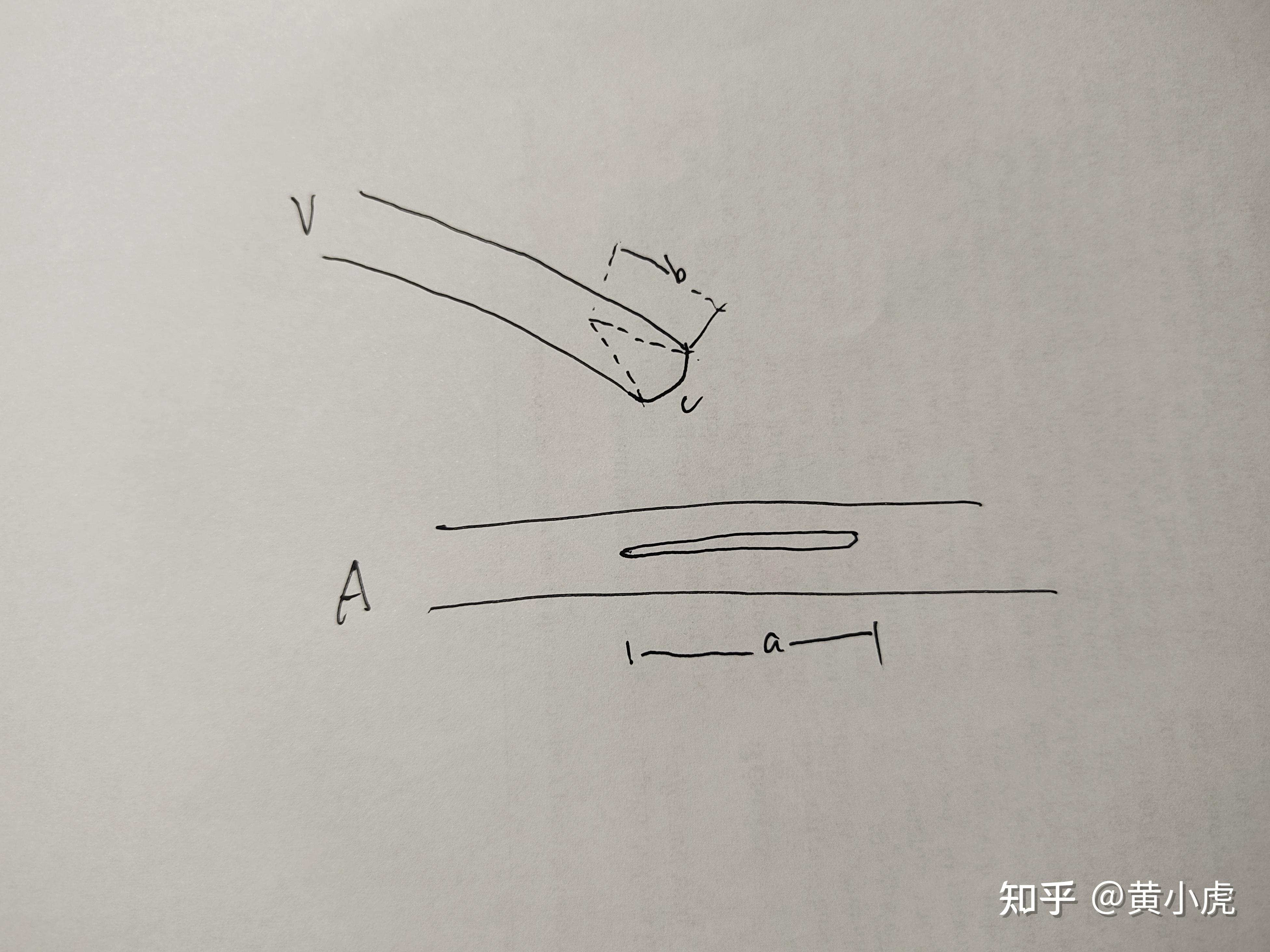 AVF成型时静脉切开长度与动脉切开长度的关系。 - 知乎