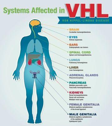 什么是VHL综合征？ - 知乎