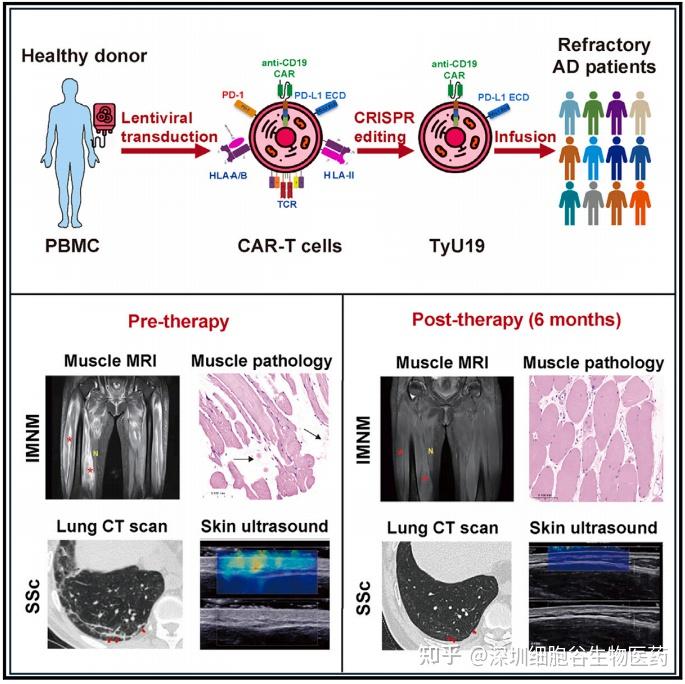 文献分享| Cell：通用型CAR-T细胞在自身免疫性疾病上的首次成功应用 - 知乎