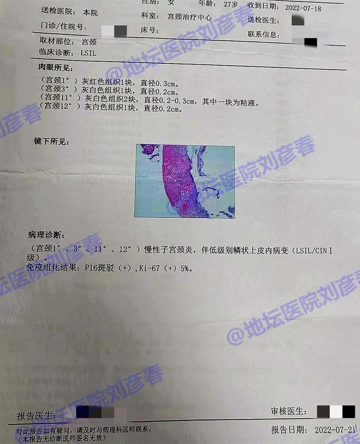 到底哪种方法才是治愈hpv及cin(宫颈病变)的最有效方法? 知乎