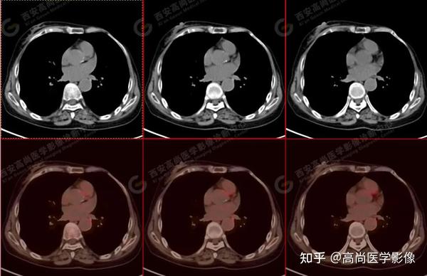 PET/CT-MR多模态病例：脾脏罕见良性肿瘤，诊断难度大导致误切除1例【高尚医学影像】 - 知乎