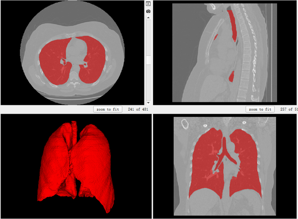 LUNA16 肺结节检测数据集介绍 - 知乎