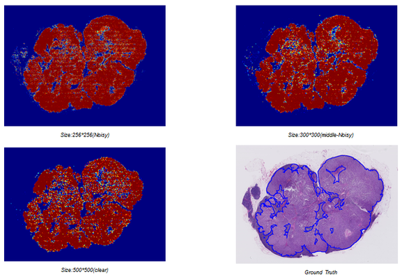 Camelyon Challenge: 癌症细胞区域检测竞赛_camelyon16冠军-CSDN博客