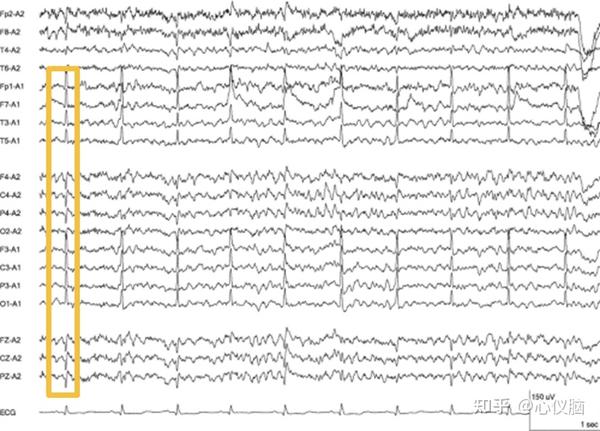 你知道EEG信号采集中的伪迹都有哪些吗？ - 知乎