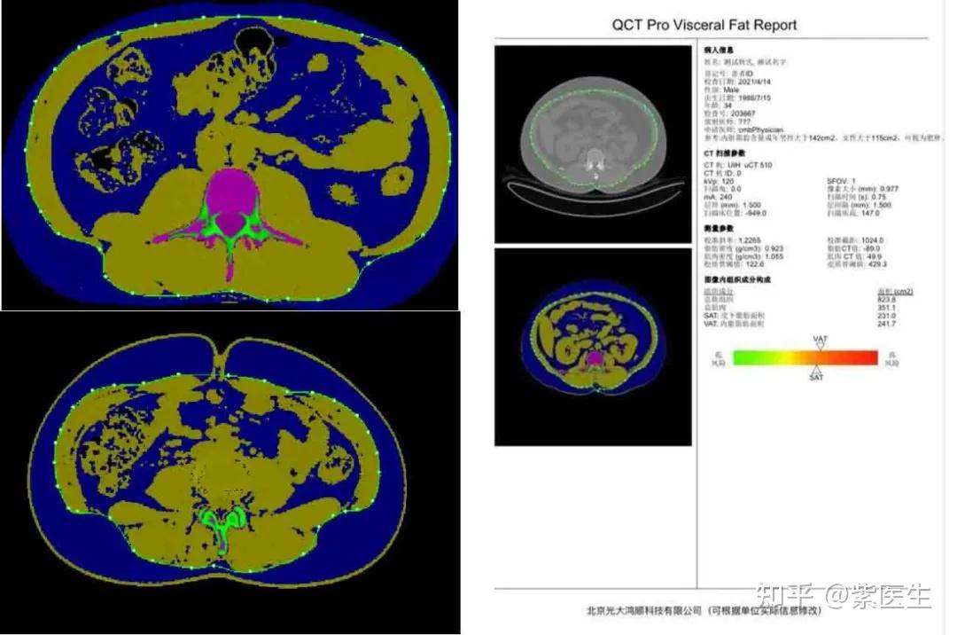 定量CT（QCT）是什么？临床应用有哪些？ - 知乎