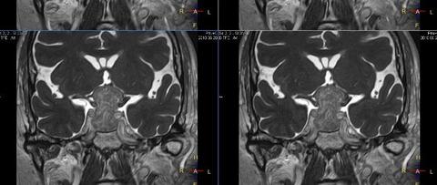 MRI增强扫描必须结合脂肪抑制技术吗？ - 知乎