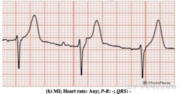 deep learning methods for ECG arrhythmia classification - 知乎