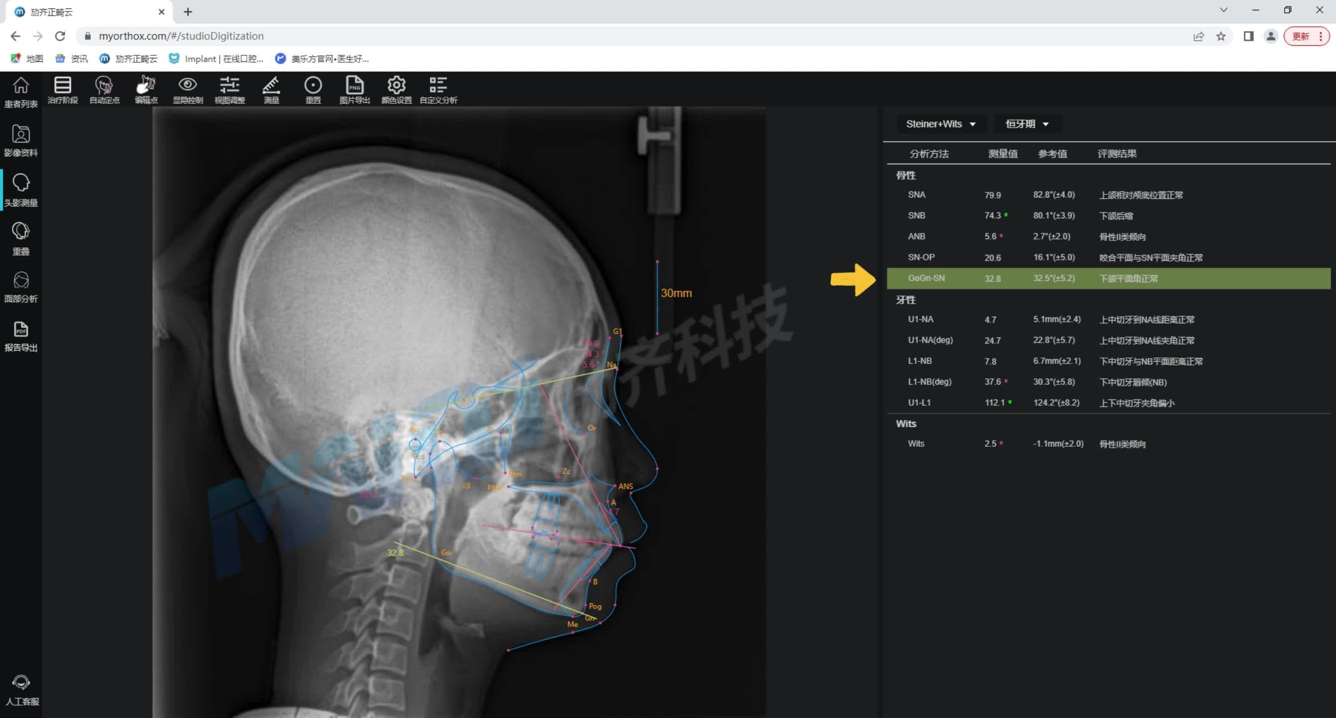【劢齐科技】头影测量常用分析法—Steiner分析法 - 知乎