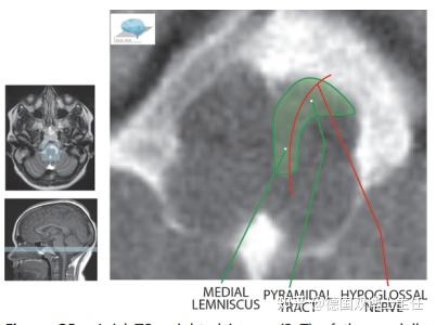 图文并茂：快速了解延髓解剖结构及常见综合征 - 知乎