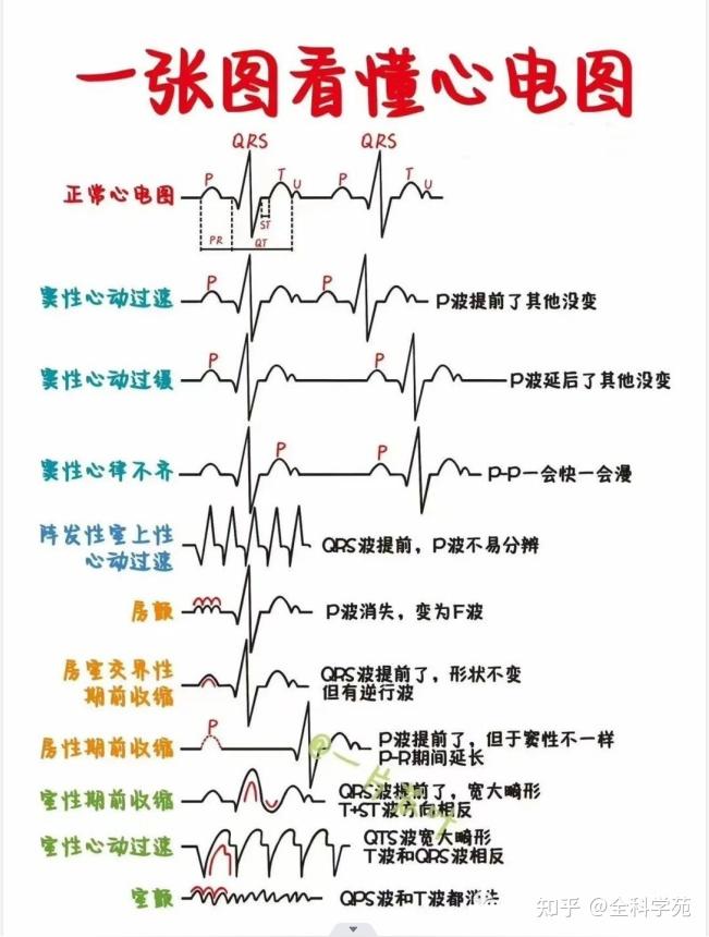 一张图看懂心电图 #心电图# - 知乎