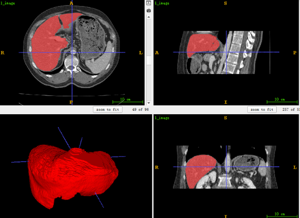 Liver Segments Ct