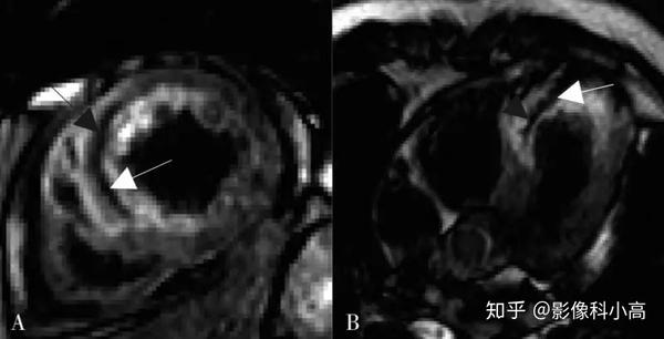 科普|CMR-心梗后微循环障碍 - 知乎