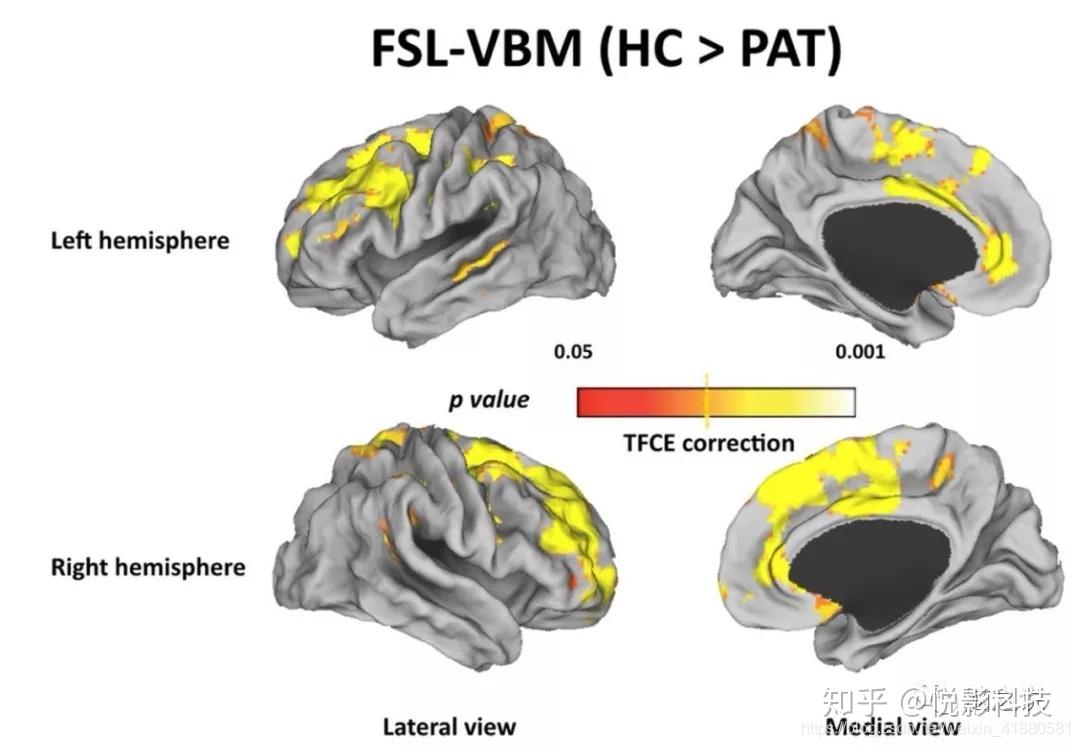 不同的工具包对Voxel-based morphometry (VBM)计算结果的影响 - 知乎