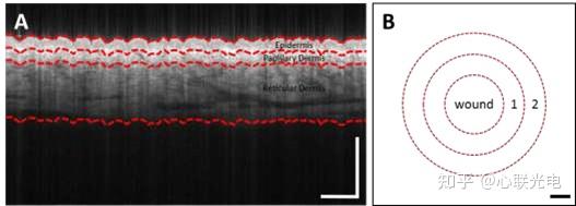 OCTA与皮肤伤口愈合——OCTA监测急性创伤及愈合过程中的结构和脉管系统变化 - 知乎