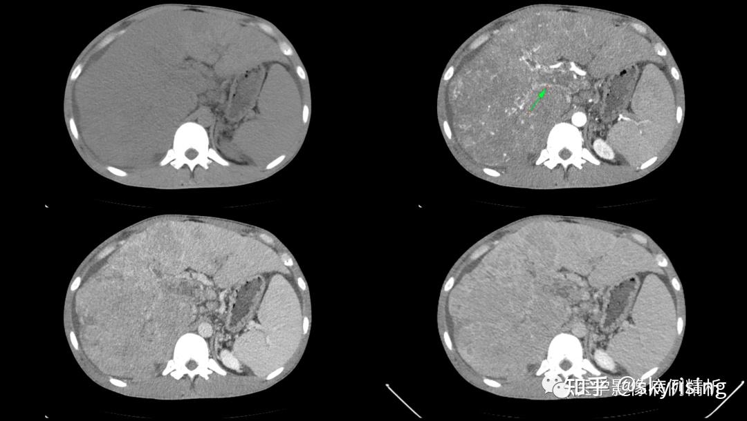 浅谈CT增强技术对影像图片显示质量影响及解决方法并肝脏恶性肿瘤、多发转移报告范例（全文） - 知乎