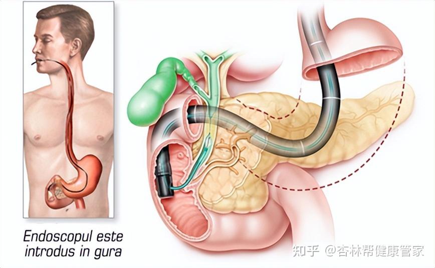 ERCP是什么检查？ - 知乎