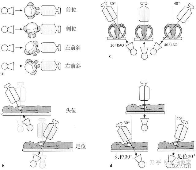 冠状动脉造影那些事儿，一文教你弄懂！ - 知乎