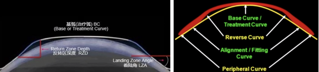 CRT设计和VST设计角膜塑形镜的区别 - 知乎