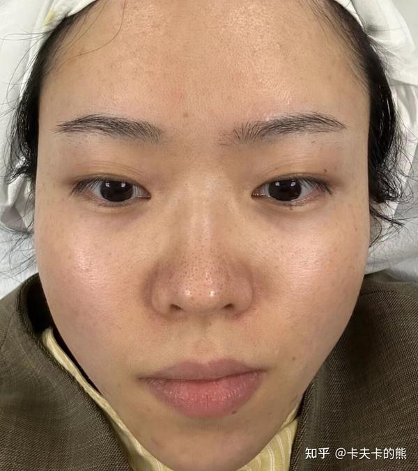 怎样可以祛黑头? 知乎