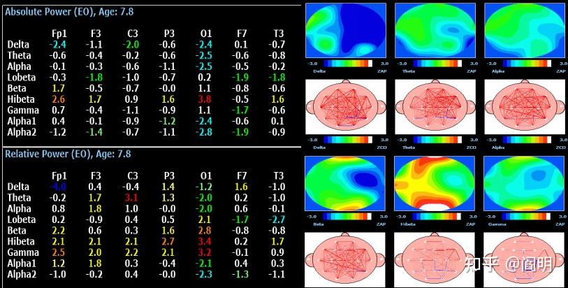QEEG在抑郁症等神经系统疾病诊断中的应用 - 知乎