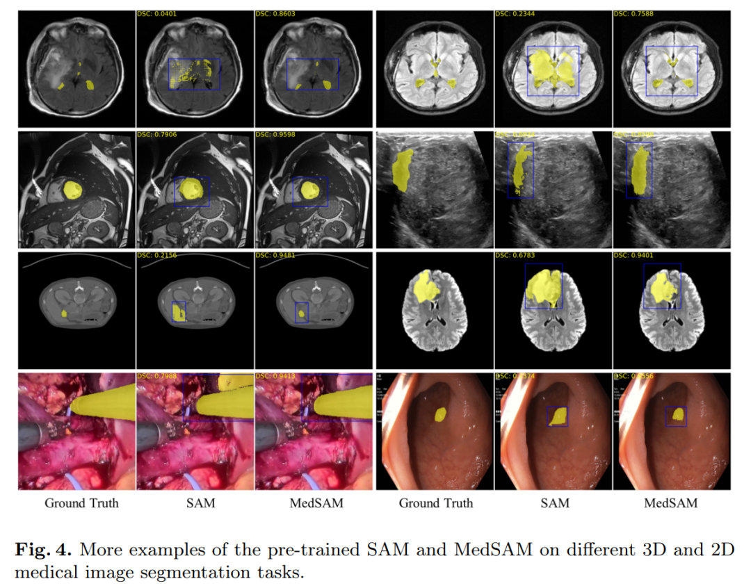 通用AI大型模型Segment Anything在医学图像分割领域的最新成果！ - 知乎