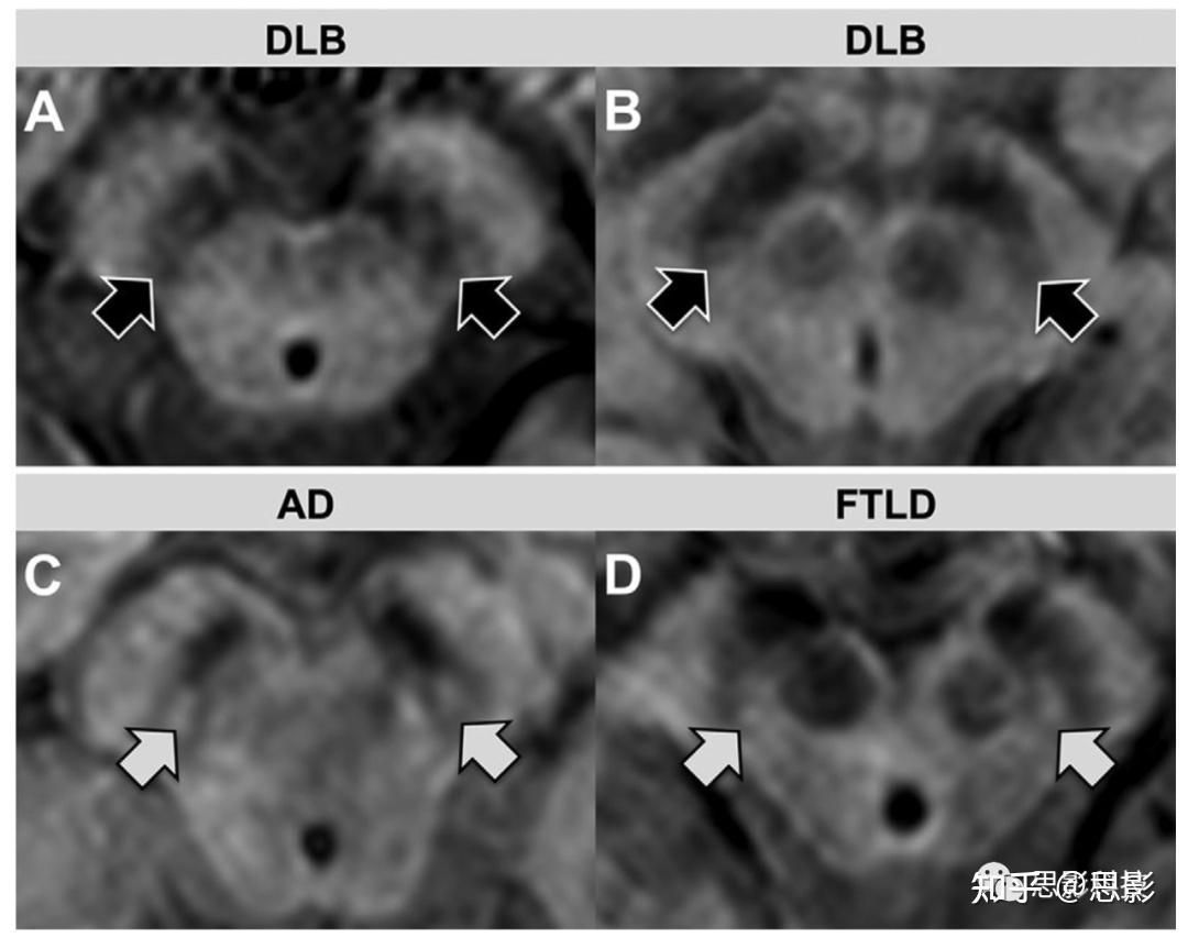 磁敏感加权成像（SWI)：技术要点和临床神经学应用 - 知乎