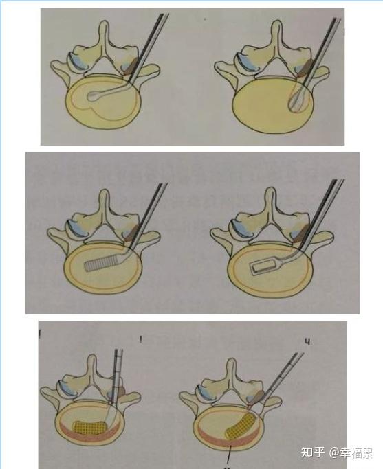 UBE 这些差别你知道吗？PLF PLIF TLIF DLIF XLIF 手术技术对比【医术苑】科普 - 知乎