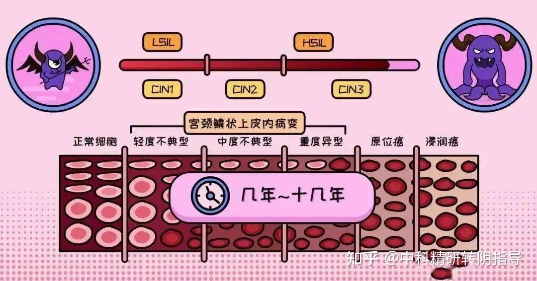 宫颈cin3需要切除子宫吗？ 知乎
