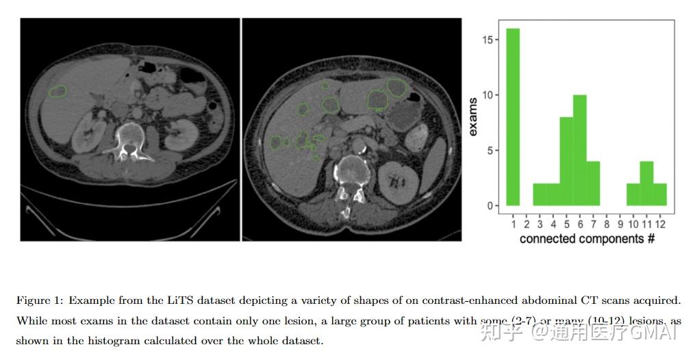 LiTS 数据集介绍 - 知乎